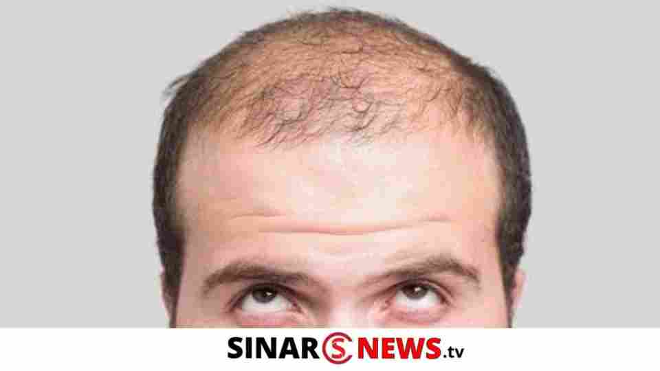 Tips Kesehatan : Penyakit yang Bikin Rambut Rontok, Menipis, Hingga ...